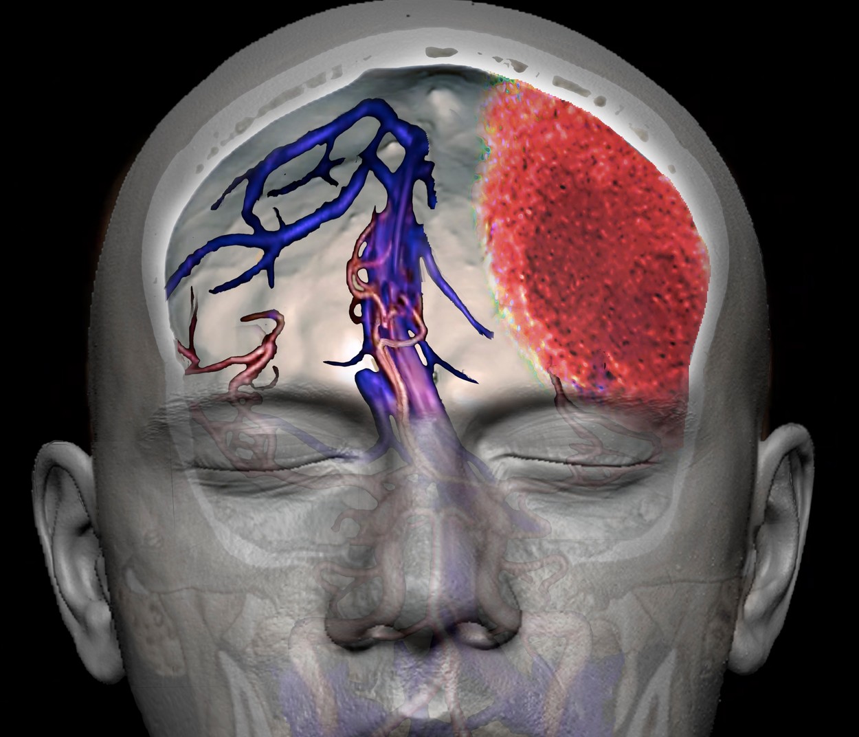 Semnul de avertizare a accidentului vascular cerebral care lovește ...